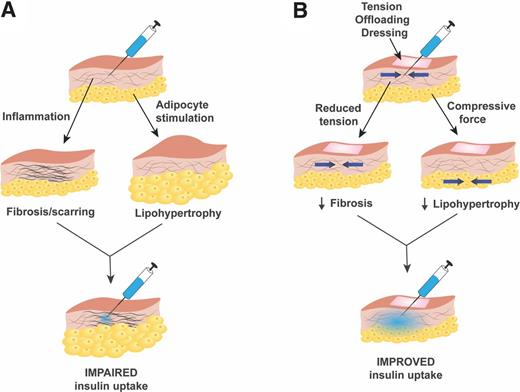 Leveraging Mechanical Forces to Target Insulin Injection–Induced ...